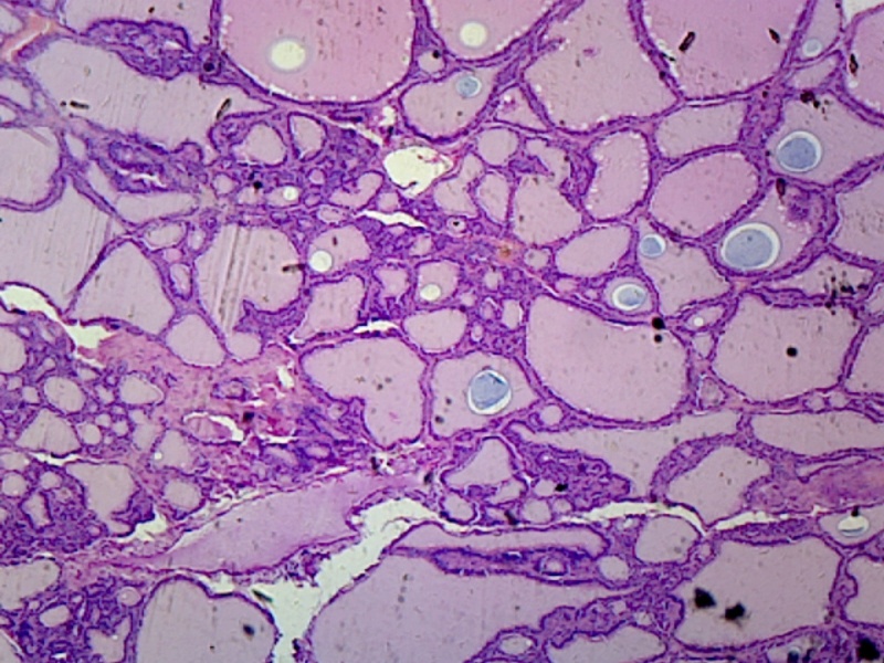 Gsc International Goiter Human Endocrine System Section H E Stain Gsc International Goiter Human Endocrine System Section H E Stain
